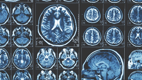 How Rotational Forces in Crashes Cause Brain Injuries | Twenge ...